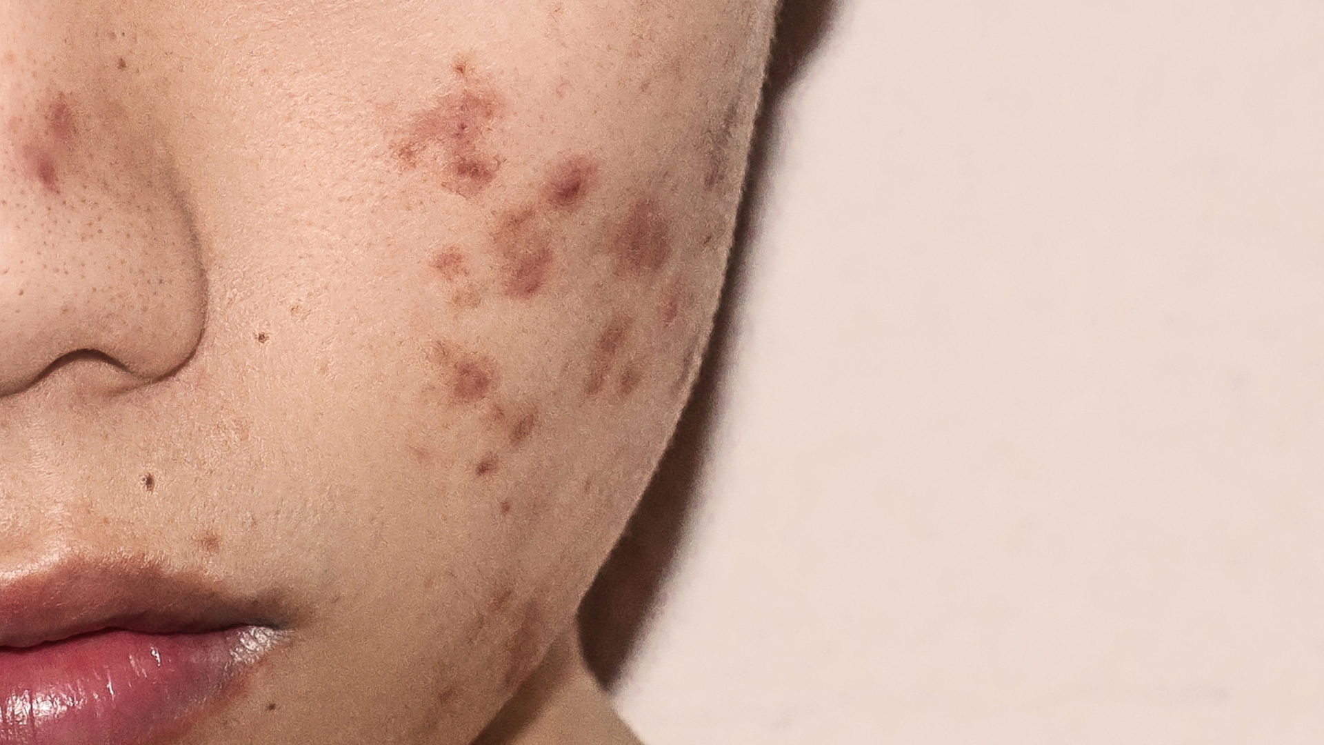 Ketahui 5 Jenis Jerawat dan Tips Mengatasinya - Promo & Artikel Terbaru ...