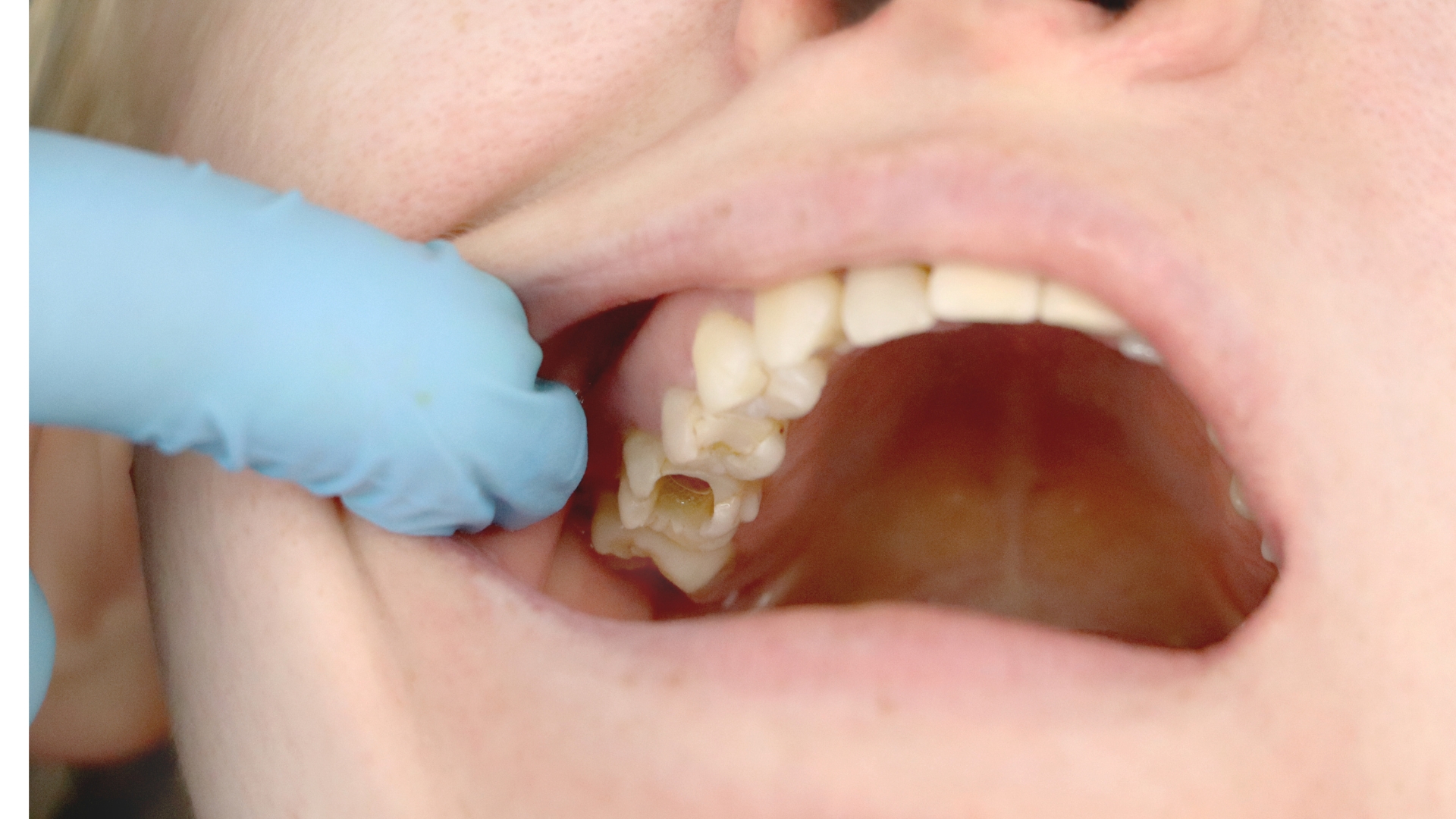 Sakit Gigi Karena Berlubang? Atasi dengan Cara Ini! - Promo & Artikel ...